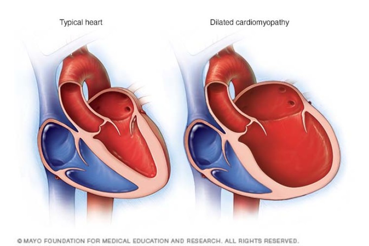 How cardiomyopathy affects the heart health?